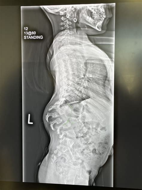 What Is Mps1 The Kennedy Ladd Foundation