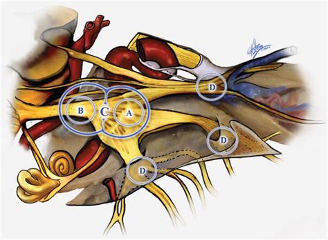 Trigeminal Schwannomas Intechopen