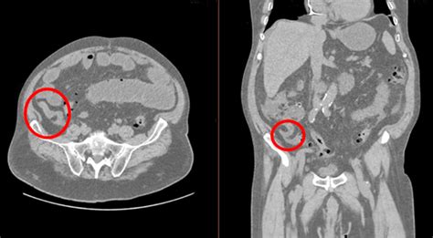 Meckels Diverticulum A Rare Cause Of Small Bowel Obstruction In Adults