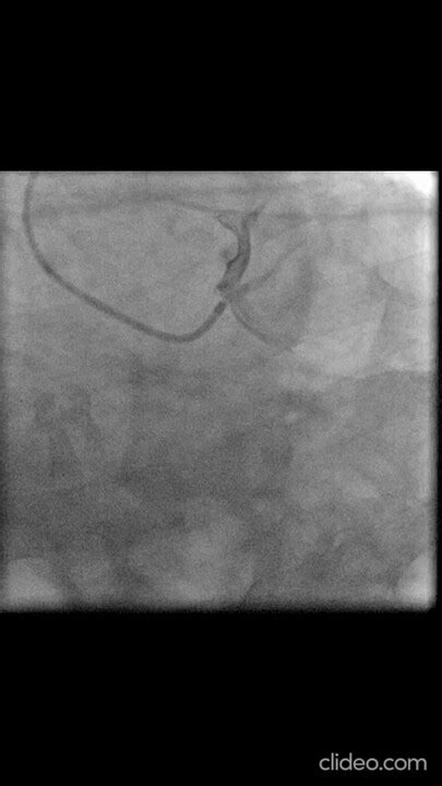 Giovanni Lorenzoni On Linkedin Mid Lad Occlusion In Anterior Stemi Timi 0 Ebu 3 0 6 Fr