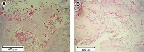 Histologic Features Of The Lesion Osteoid Matrix Producing And Highly