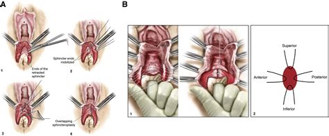 Repair Of Episiotomy And Obstetrical Perineal Lacerations First Fourth