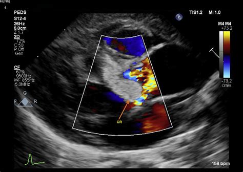 Parasternal Long Axis View With Color Doppler Showing The Degree Of Download Scientific Diagram