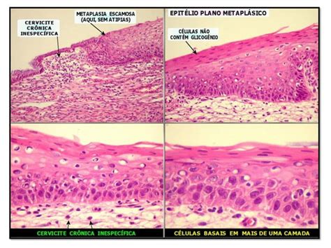 Hiperplasia Atrofia Y Metaplasia Pdf Medical Health