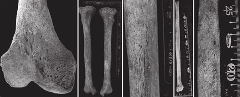Long Bones Lower Limbs Periostitis And Periosteal Reactions 1 Right