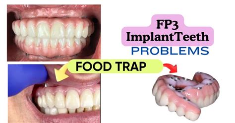 Dont Get Fp3 All On 4 Implants Essential Insights For Patients