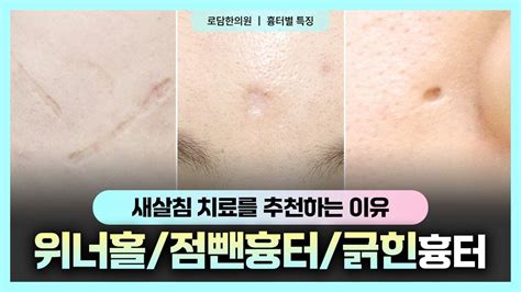 위너확장모공점뺀흉터긁힌상처흉터 새살침 치료 효과는 Youtube