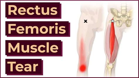 Rectus Femoris Muscle Tear Meded Cases