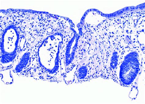 This Medium Power View Of Mycophenolate Colitis Shows Dilated And Download Scientific Diagram