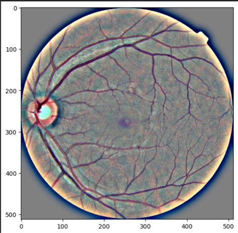 Eyesnap Diabetic Retinopathy Detection With Diascan Devpost