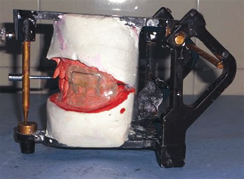 Preoperative Photograph Fig 2 Guide Flange Prosthesis Over