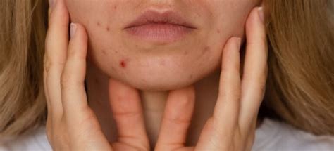 Meth Sores Causes Treatment And Recovery What Are Meth Sores