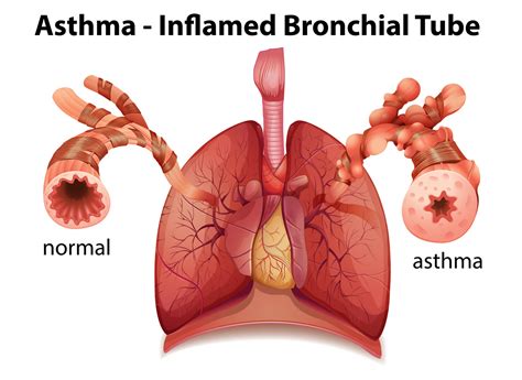 How To Know If You Have Bronchial Asthma At Glenn Barbee Blog