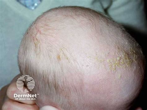 Neonatal Seborrheic Dermatitis Dermnet