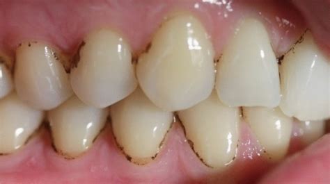 10 Causes Of Black Spots On Teeth And Solutions Best Smiles