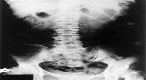 Septic Arthritis Of The Hip Secondary To Acute Cholangitis