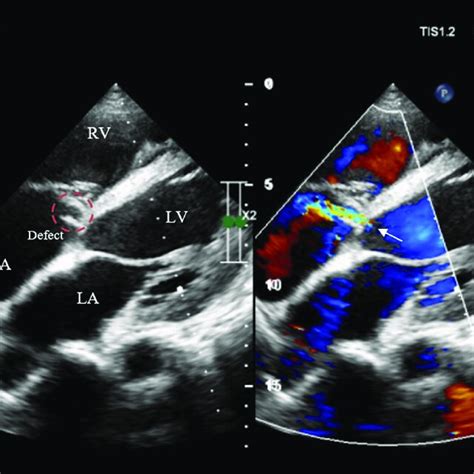 Three Types Of Gerbode Defect Normal Interventricular Septum A