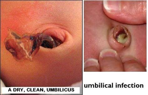 Omphalitis Or Umbilical Medical Information طبی معلومات Facebook