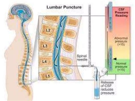Cerebrospinal Fluid Csf Examination Under Microscope Pptx