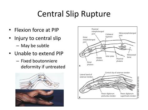 Ppt Sports Related Hand And Wrist Injuries Powerpoint Presentation