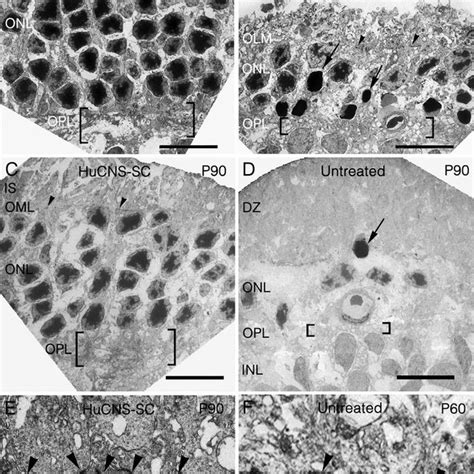 Normal Synaptic Contacts In The Outer Plexiform Layer Were Absent In