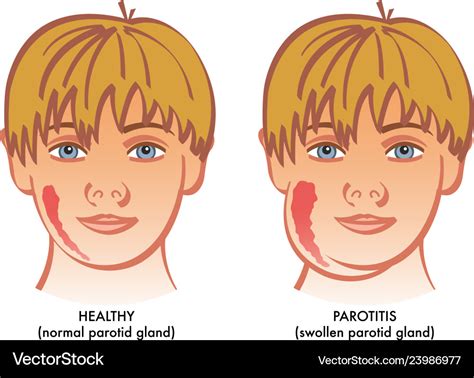 Parotitis Royalty Free Vector Image Vectorstock