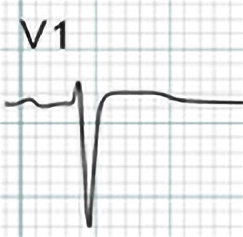 Normal Ecg Variants Quiz 12 Lead Ecg Practice Test Online Acls