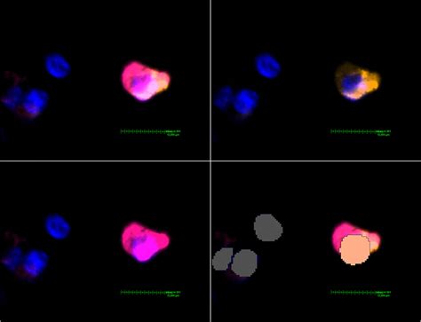 Mhc Class Ii Expressing Mdc Found In A Non Dad Lung Lobe Upper Left