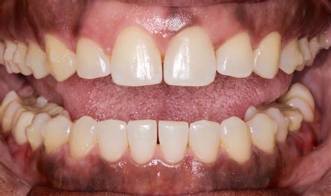 How To Simplify Interproximal Reduction