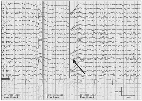 Normal Eeg Tracing