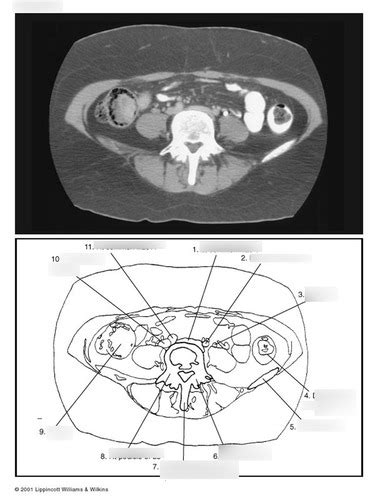 CT Axial Sectional Female Pelvis Labeling Flashcards Quizlet