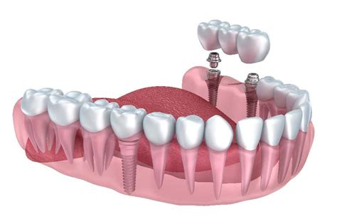 Tips To Help You Lower The Cost Of Your Dental Implant Surgery Times