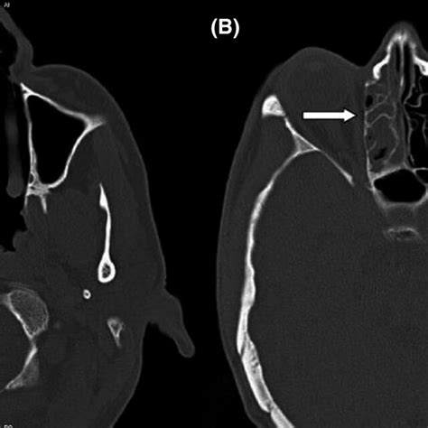 Computed Tomography Ct Scans Of The Sinuses In Invasive Aspergillus