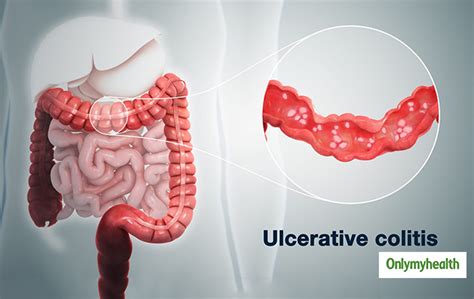 Infectious Colitis