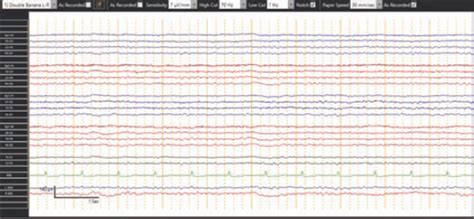 Normal Versus Abnormal Eeg