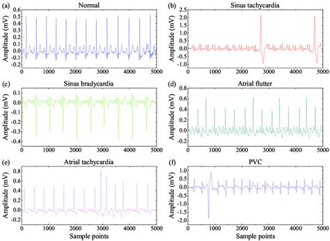 The Lead Ii Ecg Signals Of Different Arrhythmias Mv Represents