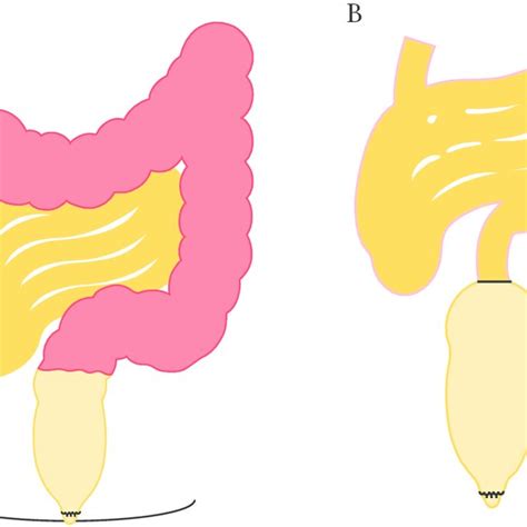 Montreal Classification Of Extent And Severity Of Ulcerative Colitis Download Scientific