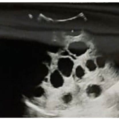 Abdominal U S Reveals Diffuse Involvement Of The Liver With Hypoechoic Download Scientific