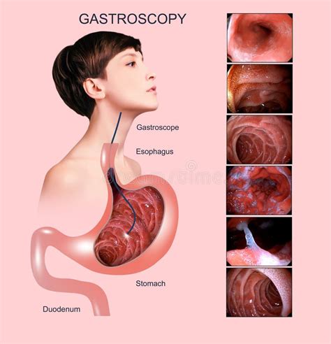 Digestive Endoscopy Or Gastroscopy Performing A Gastroscopy Procedure