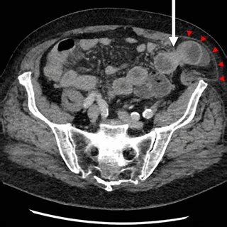 The Asymmetry Rate Of The Four Abdominal Wall Muscles The Red Dots