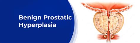 Benign Prostatic Hyperplasia Bankers Vascular Centre