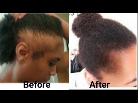 Regrow Your Bald Hair Fast Treat Thin And Bald Hair Youtube