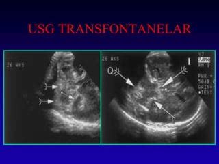Ultrasonido Transfontanelar Pptx