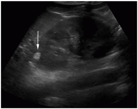 Renal Tumors Radiology Key