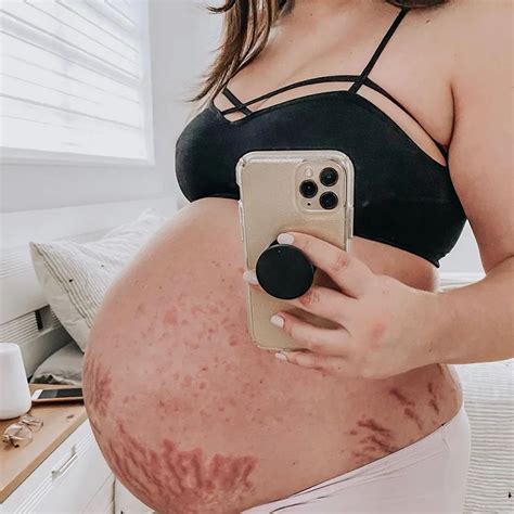 Belly Rash During Pregnancy Puppp Rash What To Know About This