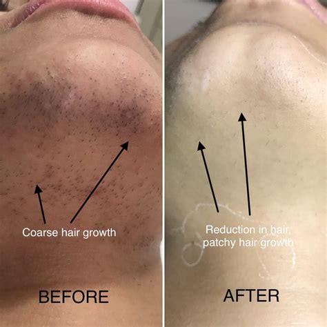 Post Laser Hair Removal Essential Dos And Donts Guide Laser Hair