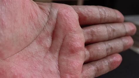 What It Really Means When Your Palms Turn Red