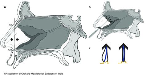 19 Septoplasty Intra Operative Steps A The Part Of The Septum