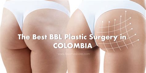 The Best Bbl Surgery In Colombia Fesamedcare Consultation With