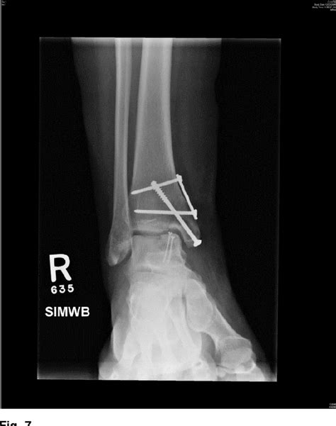 Figure 7 From Structural Allograft Transplantation For Osteochondral